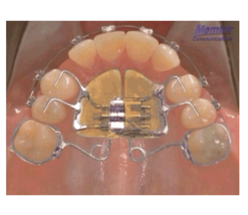 Pêndulo Hilgers - Digital Lab Institute | Laboratório de Odontologia Digital